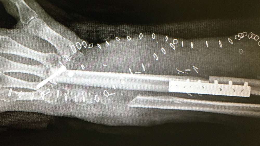 Reconstruction-osseuse-du-radius-avec-arthrodèse-radio-carpienne-par ...
