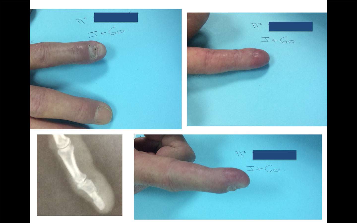 Réimplantation du 3ème doigt, mécanisme d’amputation franche par ...