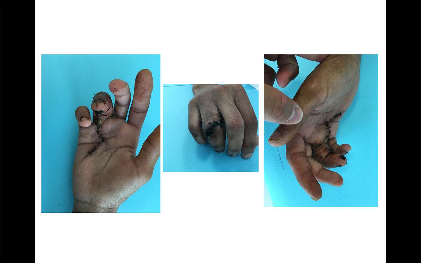 Ring finger Annulaire: réimplantation | Plexus Brachial ...